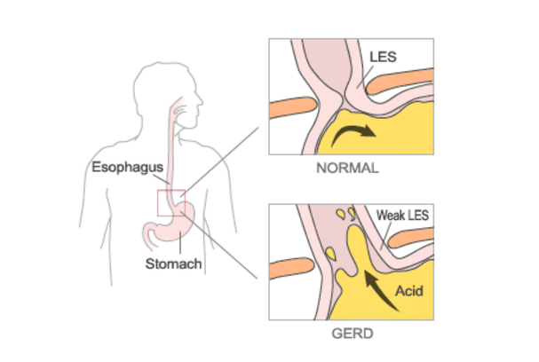 Reflux Disease (Heartburn) - Gastroenterologist